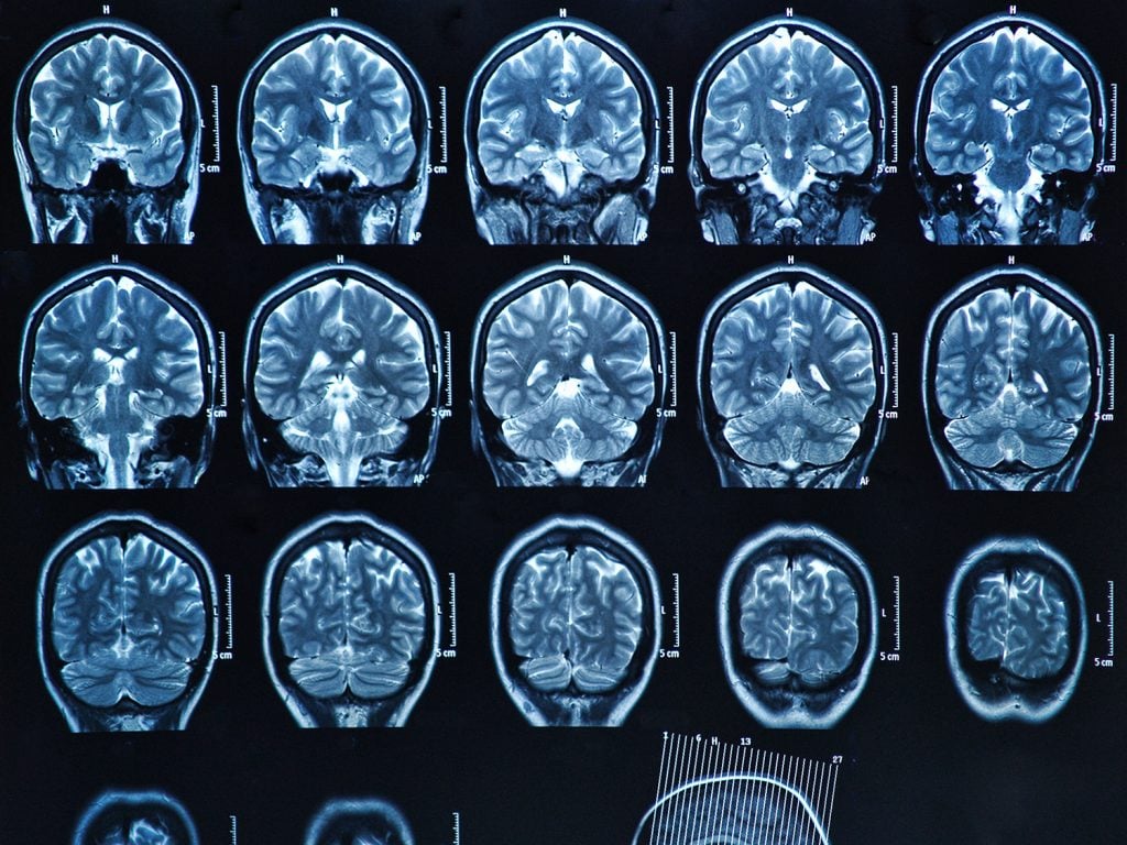 the-role-of-ct-and-mr-in-stroke-patients-qmenta